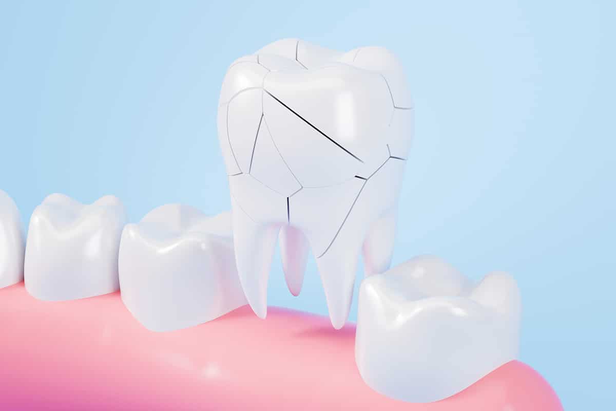 5 Signs You Cracked a Tooth - Forest Lake Endodontics