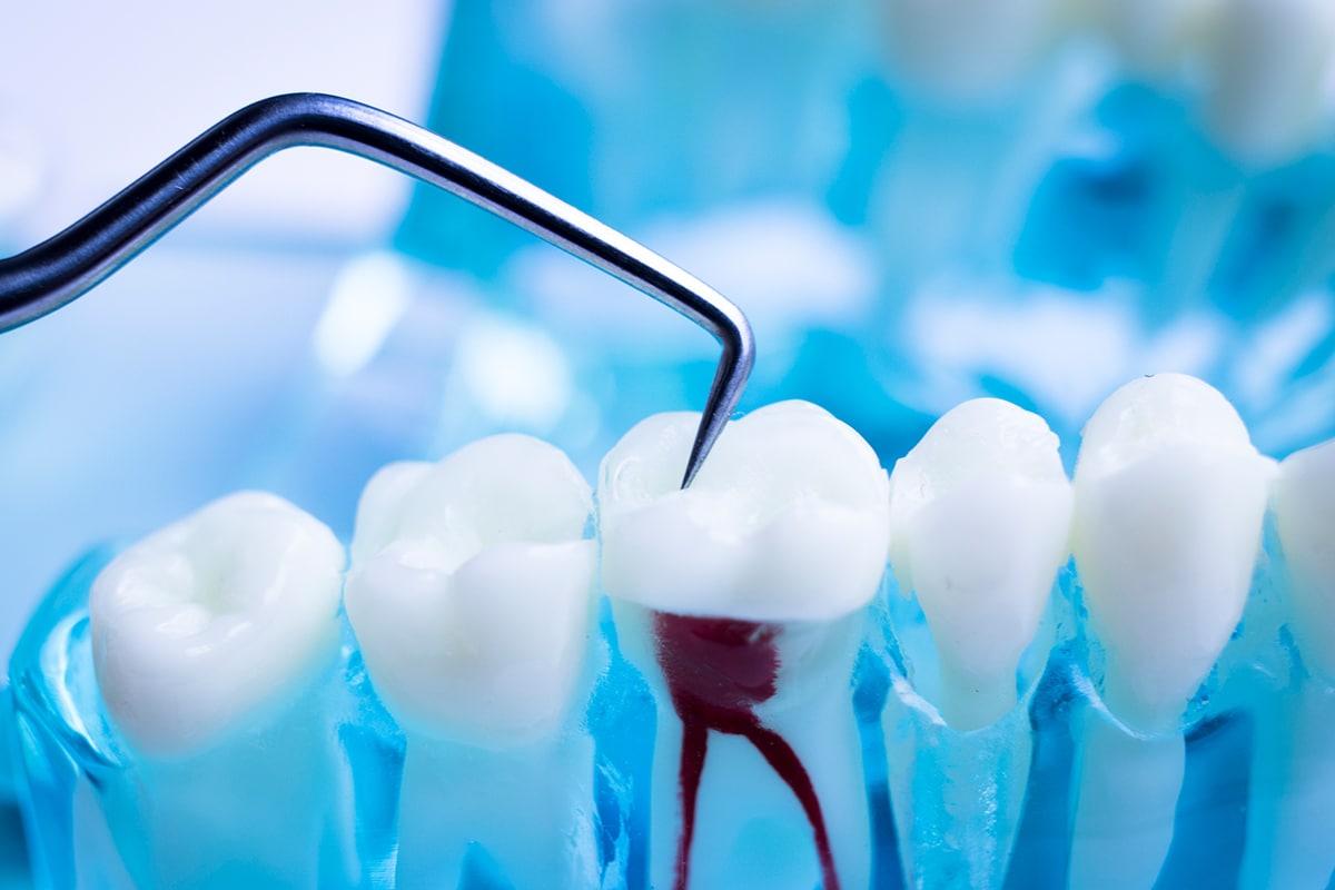 What Is The Difference Between A Root Canal & Apical Surgery? - Forest ...